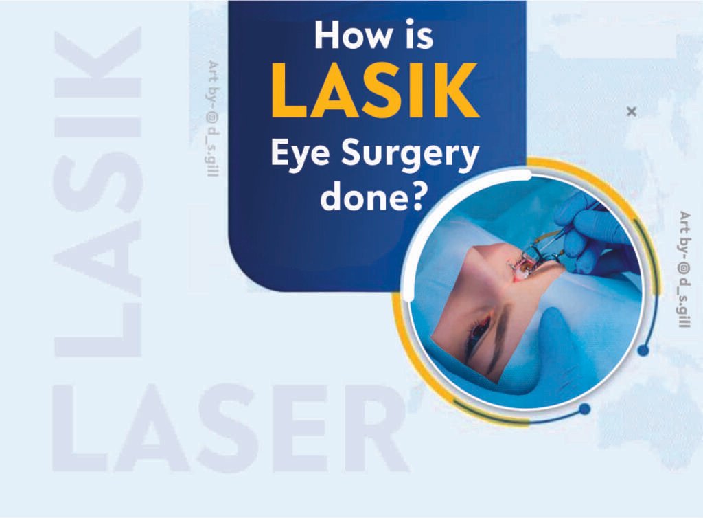 The LASIK Eye Surgery: A Step-by-Step Guide - Best eye specialist ...